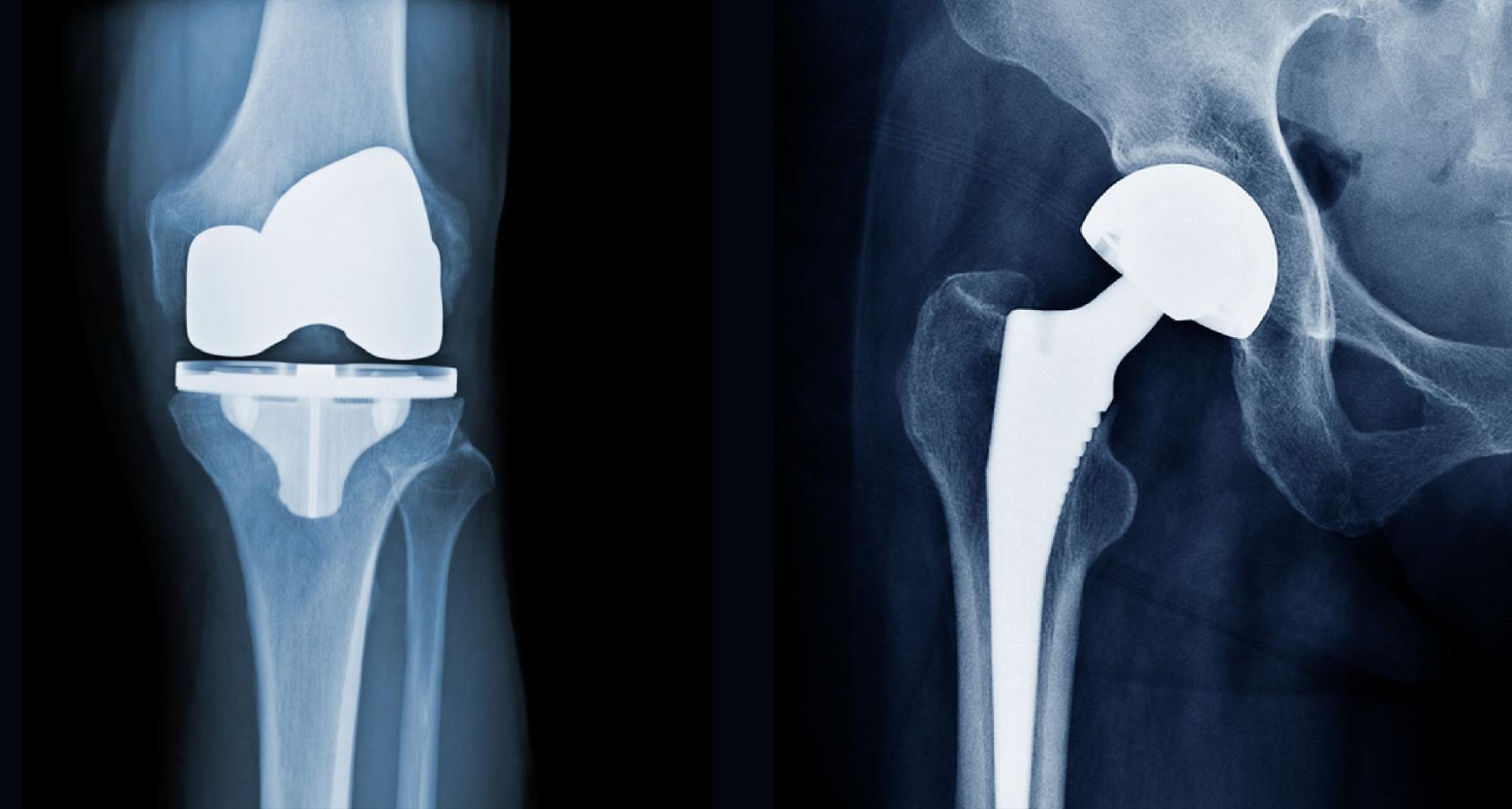 Exactech Knee & Hip Implant Lawsuit Attorneys in Louisiana | Over $1 ...